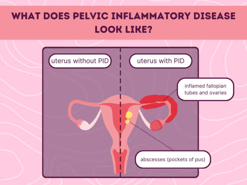 What is Pelvic Inflammatory Disease? - Teen Health Source
